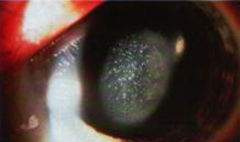 Medicine Decoded: Cataracts-Few interesting types
